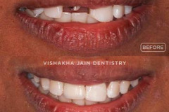 Zirconia Dental Caps in Indore | Seraphic Dental Clinic